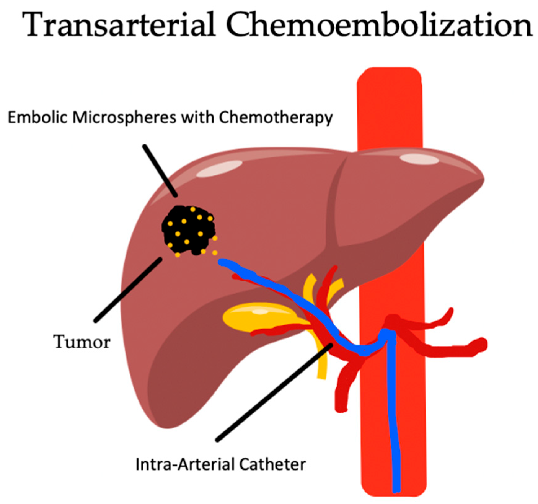Locoregional Therapies for Hepatocellular Carcinoma in Patients with ...