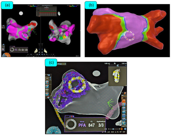 Pulsed Field Ablation of Atrial Fibrillation: A Novel Technology for ...