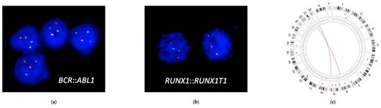 Blast Transformation of Chronic Myeloid Leukemia Driven by Acquisition of t(8;21)(q22;q22)/RUNX1 ...