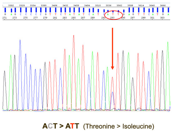 Blast Transformation of Chronic Myeloid Leukemia Driven by Acquisition of t(8;21)(q22;q22)/RUNX1 ...