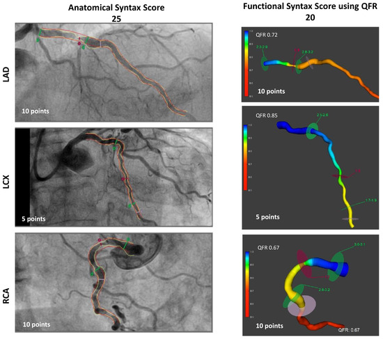 Prognostic Role of Functional SYNTAX Score Based on Quantitative Flow Ratio