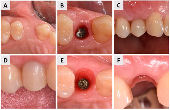 Magnesium Membrane Shield Technique for Alveolar Ridge Preservation ...
