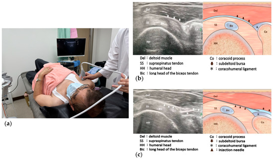 Evaluating the Effectiveness of Ultrasound-Guided Subacromial ...