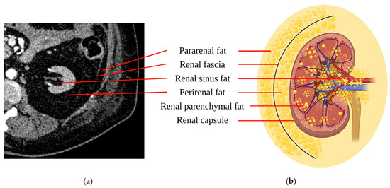 Metabolic Syndrome, Kidney-Related Adiposity, and Kidney ...