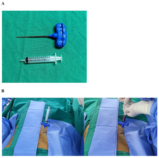 Bone Marrow Stem Cell Population in Single- and Multiple-Level Aspiration
