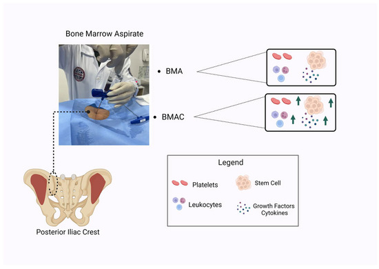 Innovative Approaches in Knee Osteoarthritis Treatment: A Comprehensive Review of Bone Marrow ...