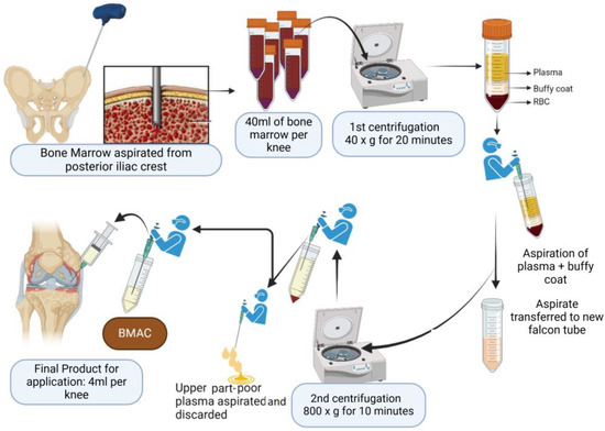 Innovative Approaches in Knee Osteoarthritis Treatment: A Comprehensive ...