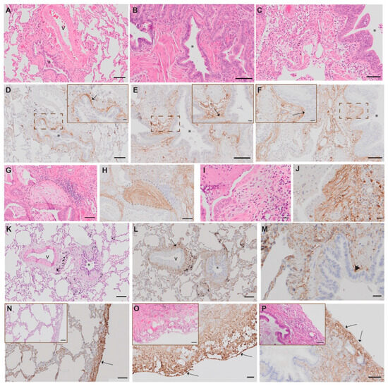 Overlapping Systemic Proteins in COVID-19 and Lung Fibrosis Associated ...