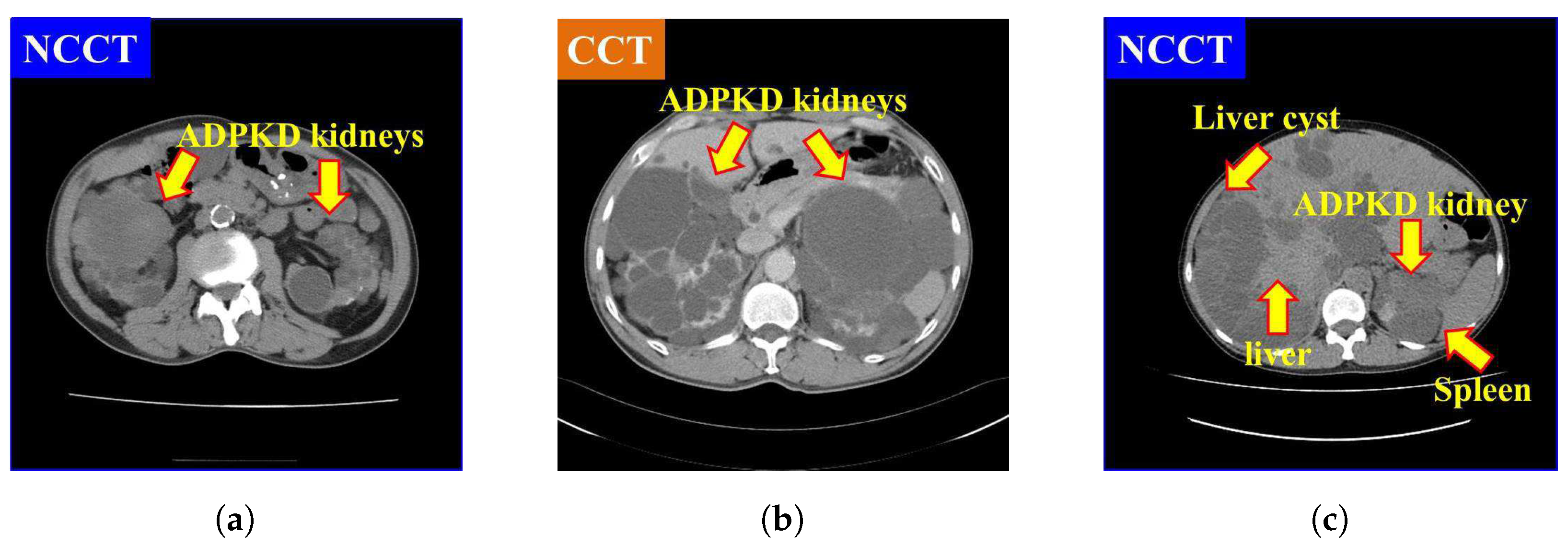Segmentation of ADPKD Computed Tomography Images with Deep Learning Approach for Predicting ...