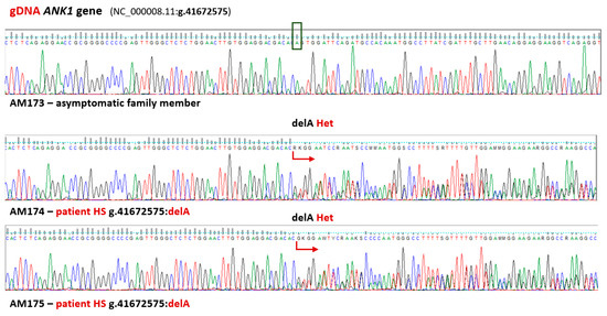 Two Variants of the ANK1 Gene Associated with Hereditary Spherocytosis