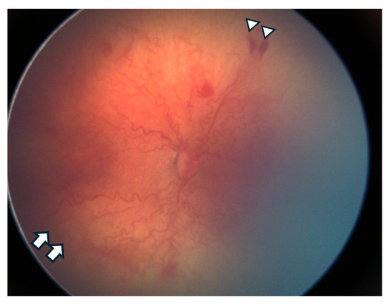 Retinopathy of Prematurity and MicroRNAs