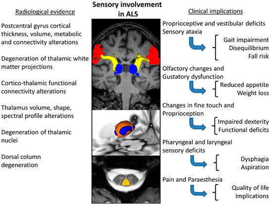 Sensory Dysfunction in ALS and Other Motor Neuron Diseases: Clinical ...