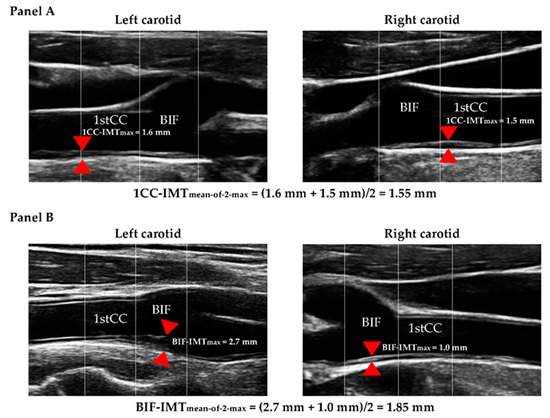 Enhancing Cardiovascular Risk Prediction with a Simplified Carotid IMT ...