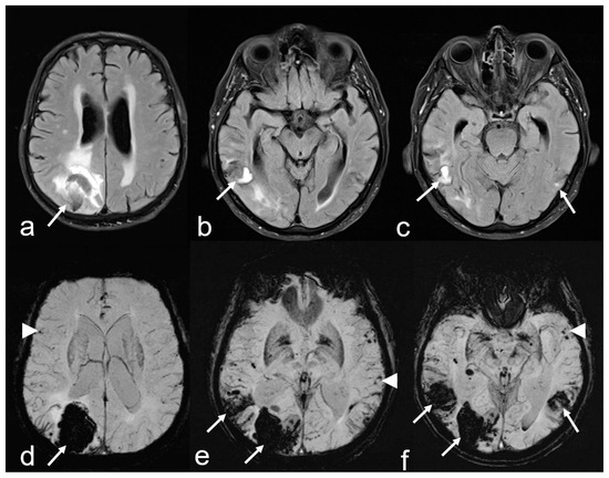 Cerebral Amyloid Angiopathy: Clinical Presentation, Sequelae and ...
