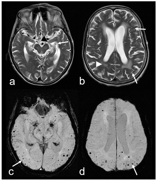 Cerebral Amyloid Angiopathy: Clinical Presentation, Sequelae and ...