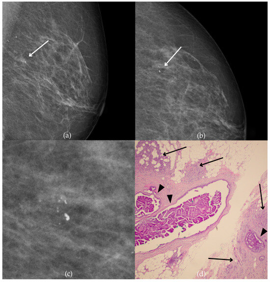 Histopathological Analysis of Vacuum-Assisted Breast Biopsy in Relation ...