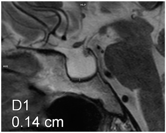 The Influence of Pituitary Morphology on the Occurrence of Hormonal ...