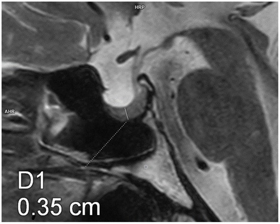 The Influence of Pituitary Morphology on the Occurrence of Hormonal ...
