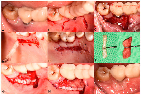 A Combined Approach Using Strip Grafts and Xenogenic Dermal Matrix for ...