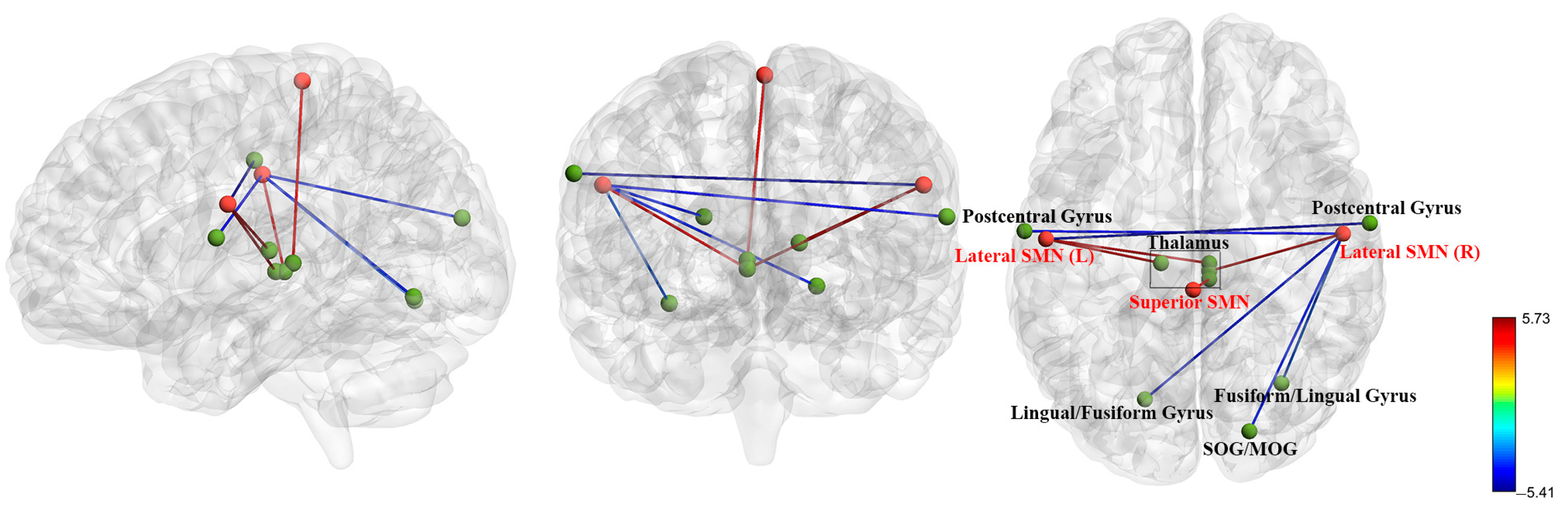 Neuroimaging Changes in the Sensorimotor Network and Visual Network in Bipolar Disorder and ...