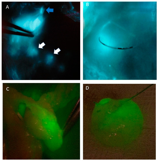 Indocyanine Green Near-Infrared Fluorescence-Guided Sentinel Lymph Node ...