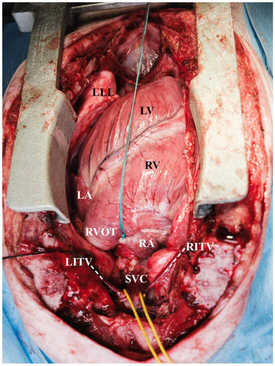 Establishment and Hemodynamic Assessment of the Superior Cavopulmonary ...