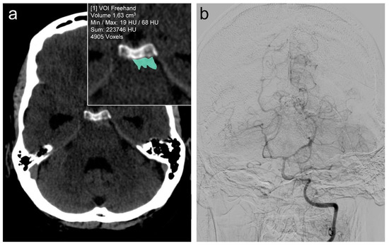 Perimesencephalic Subarachnoid Hemorrhage Is Not Always a Benign ...