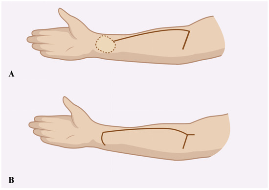 Optimizing Wound Healing in Radial Forearm Donor Sites: A Comparative ...