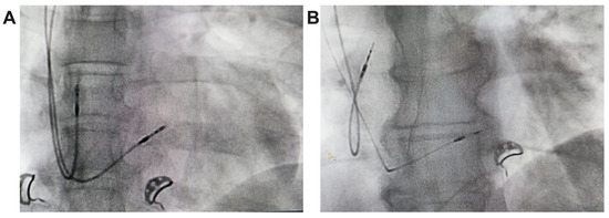 Left Bundle Branch Area Pacing Prevents New-Onset Atrial Fibrillation ...