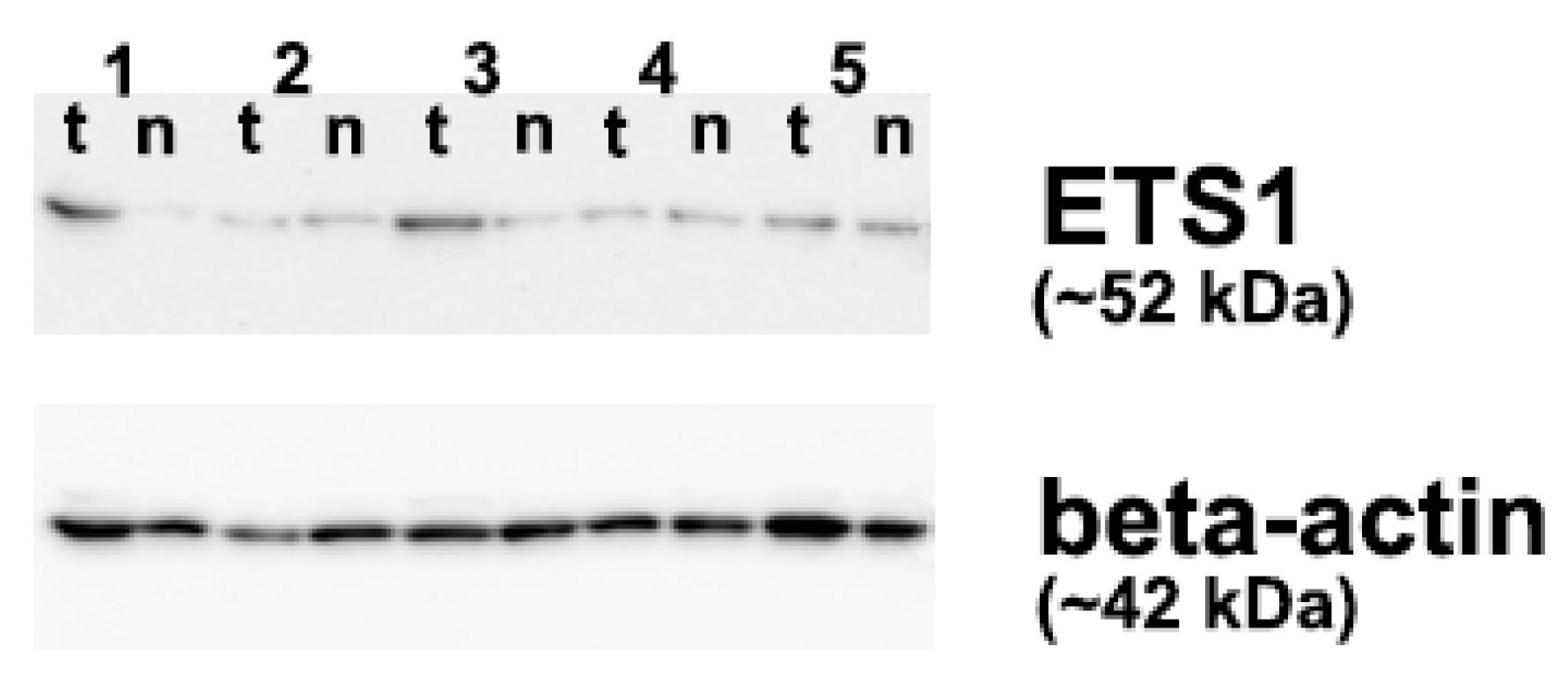 Implication of p16 Promoter Methylation, the BRAFV600E Mutation, and ETS1 Expression ...
