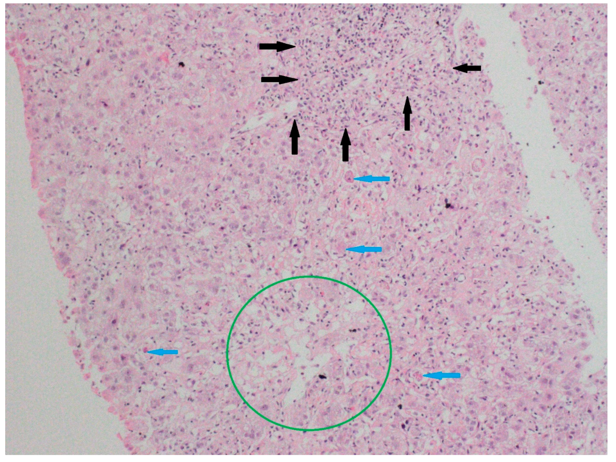 Ornidazole-Induced Liver Injury: The Clinical Characterization of a ...
