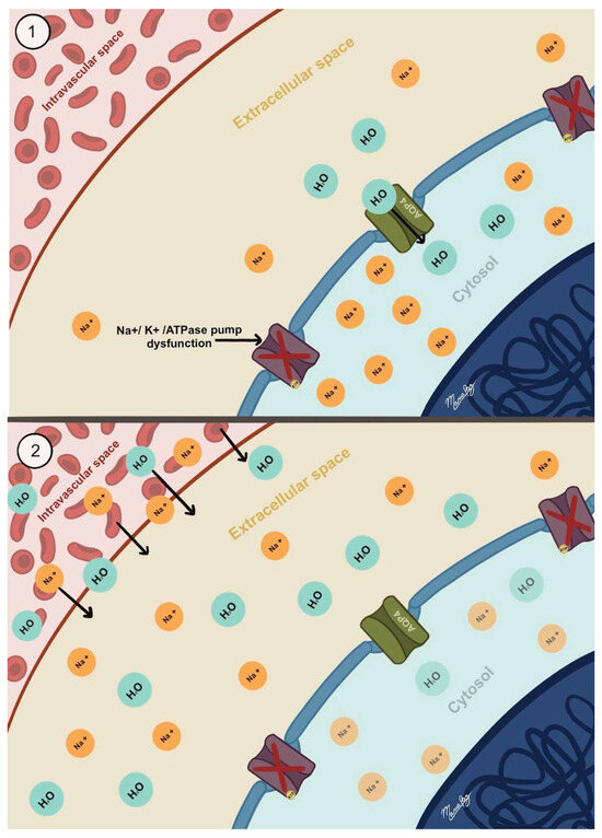 Cerebral Edema in Traumatic Brain Injury