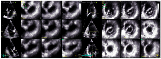 The Link Between Left Atrial Longitudinal Reservoir Strain and Mitral ...