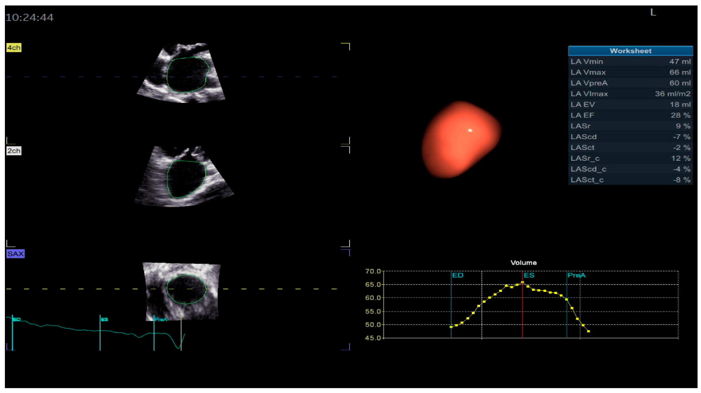 The Link Between Left Atrial Longitudinal Reservoir Strain and Mitral ...