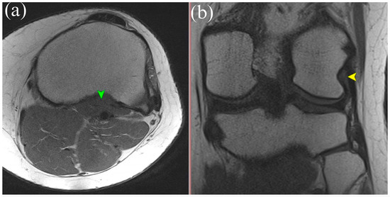 Popliteus Tendon Morphology: Anatomical Classification and Clinical ...