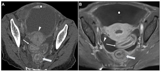 Linitis Plastica-like Metastases to the Gastrointestinal Tract on Cross ...