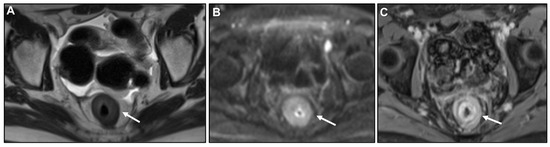 Linitis Plastica-like Metastases to the Gastrointestinal Tract on Cross ...