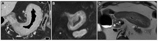 Linitis Plastica-like Metastases to the Gastrointestinal Tract on Cross ...