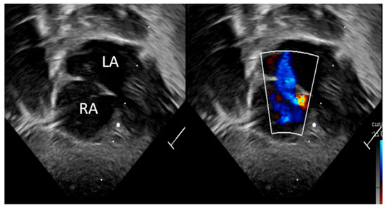 Persistent Pulmonary Hypertension of the Newborn: A Pragmatic Review of ...