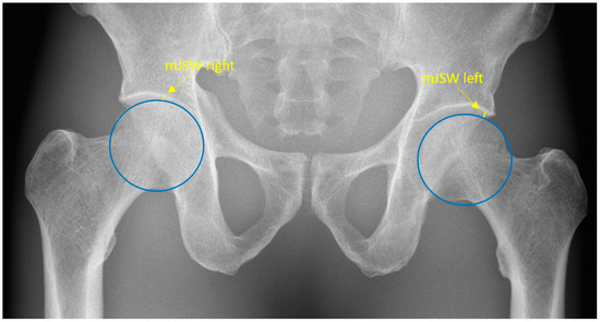 Minimal Hip Joint Space Width Measured on X-rays by an Artificial Intelligence Algorithm—A Study ...