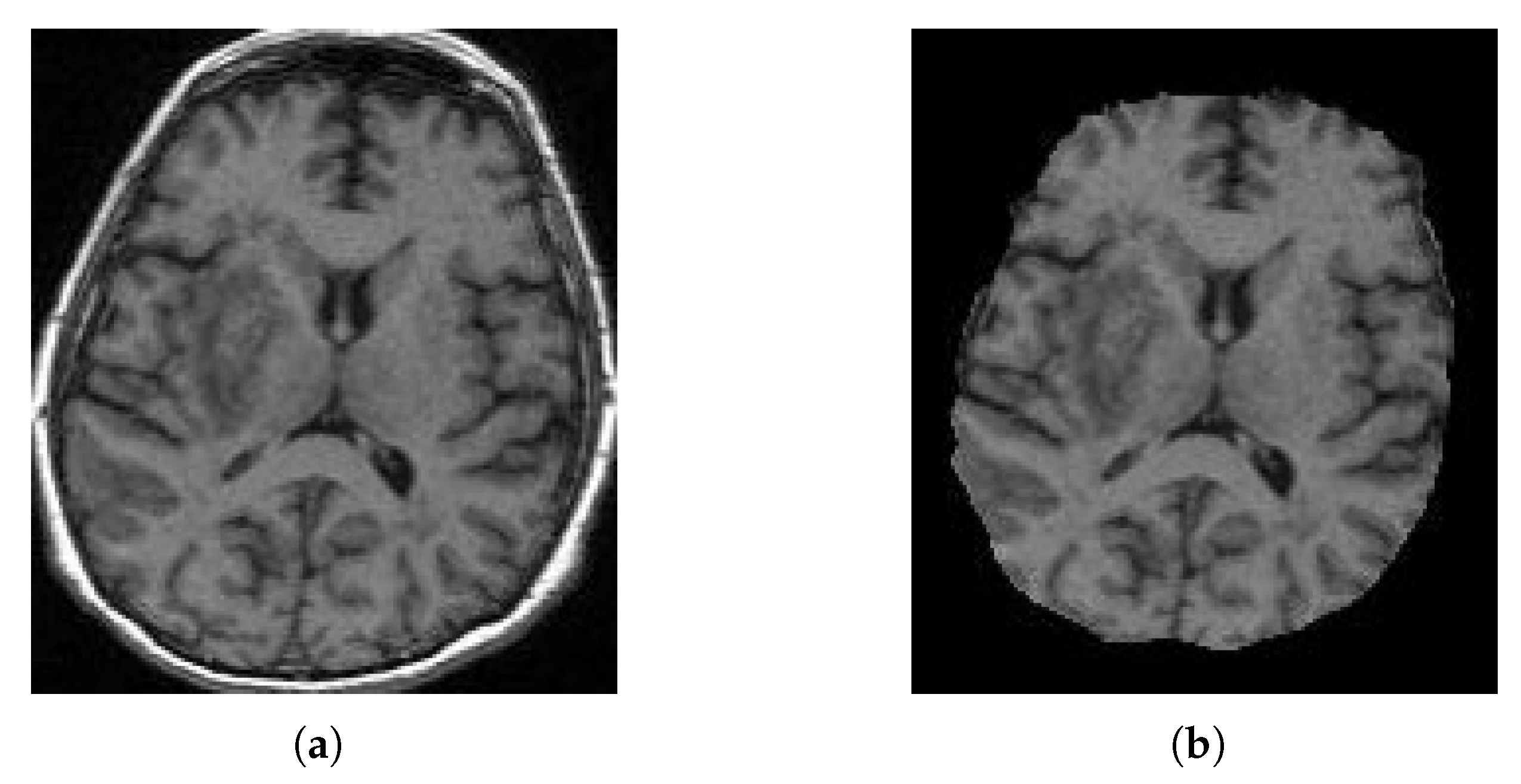 Synthetic MRI Generation from CT Scans for Stroke Patients