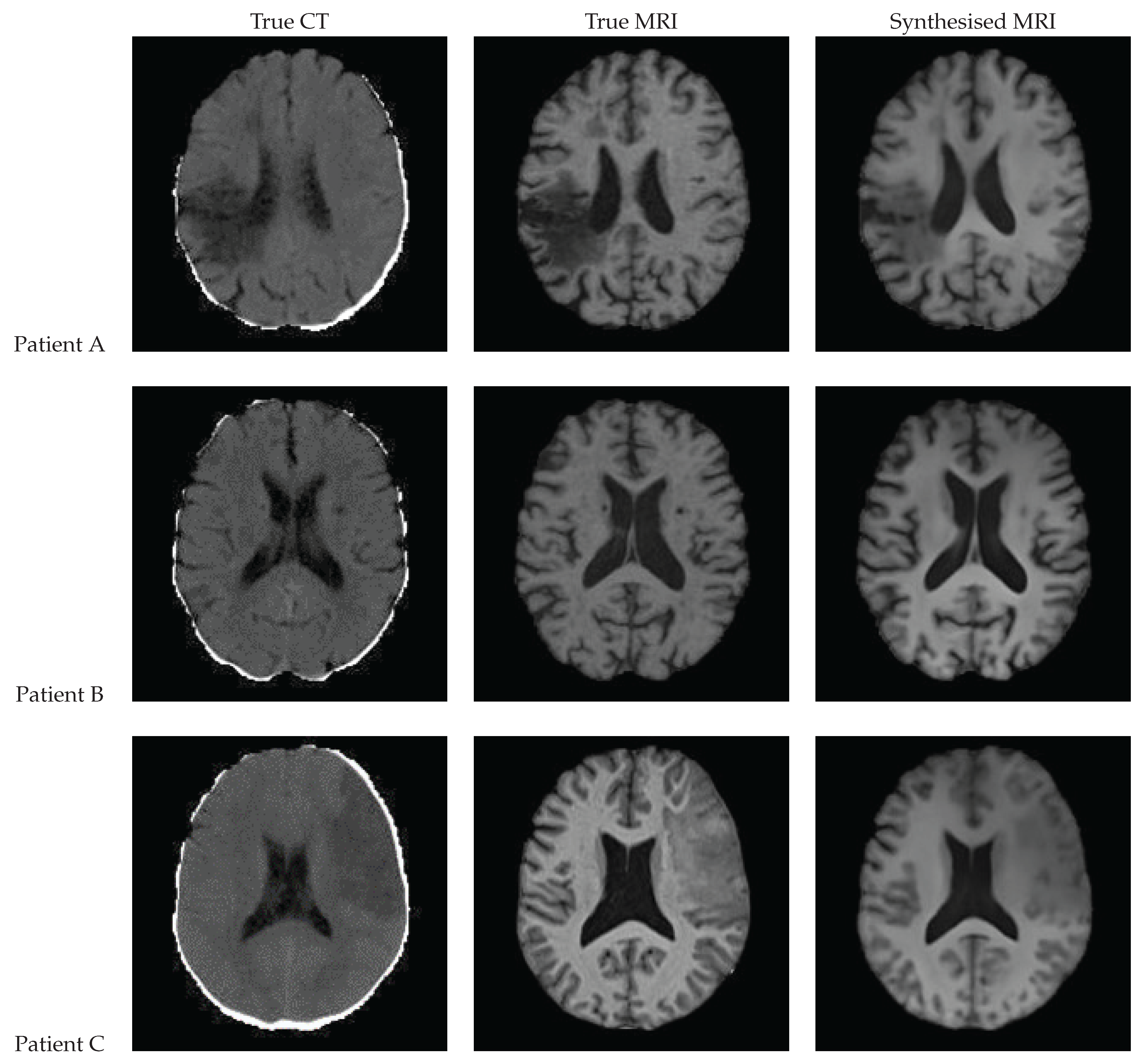 Synthetic MRI Generation from CT Scans for Stroke Patients
