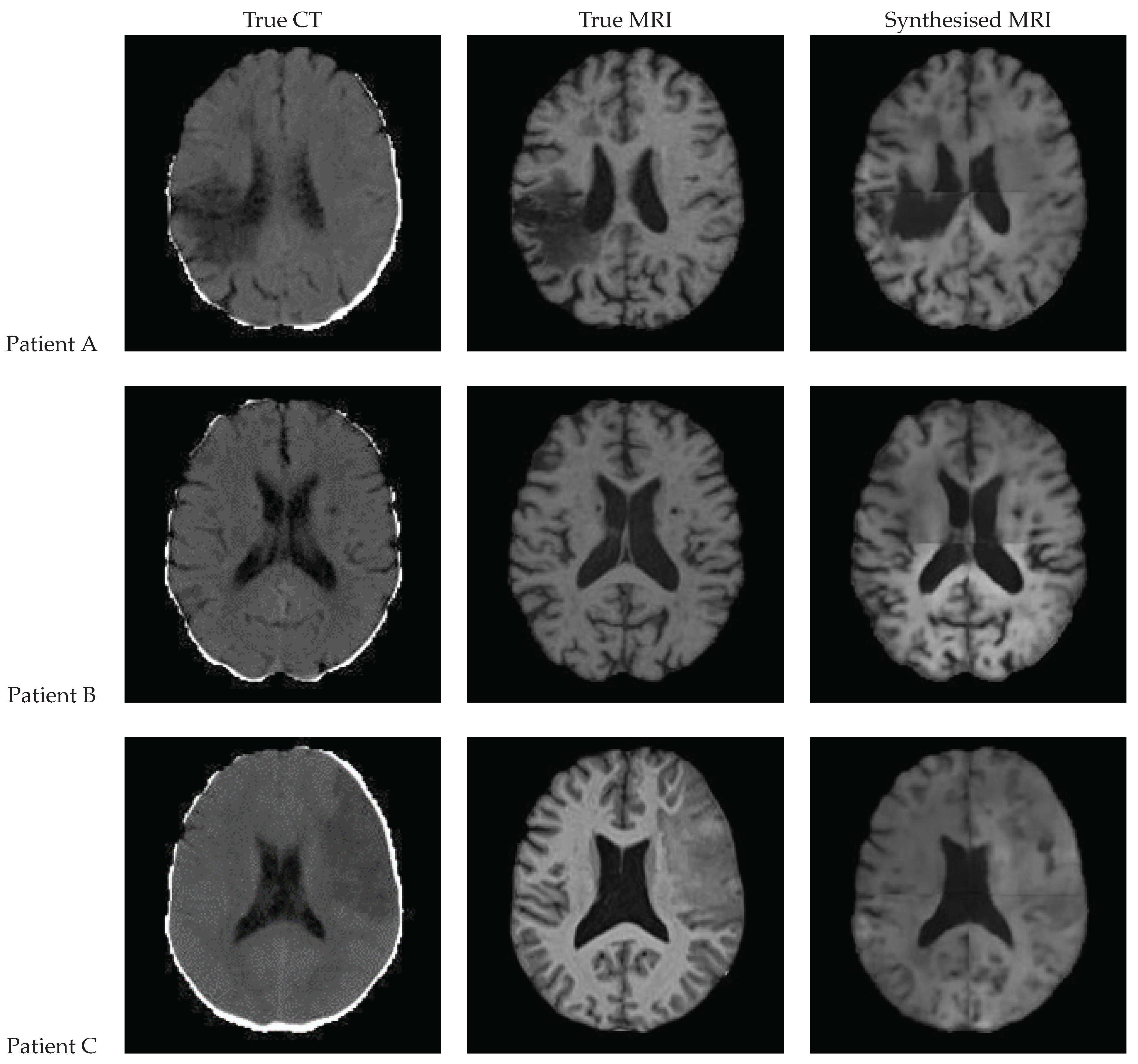 Synthetic MRI Generation from CT Scans for Stroke Patients