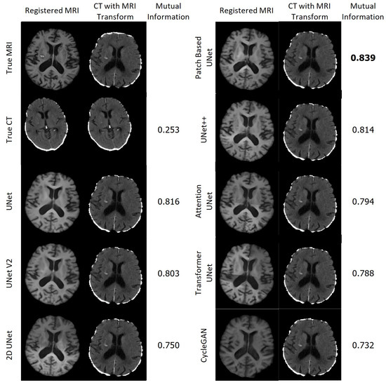 Synthetic MRI Generation from CT Scans for Stroke Patients
