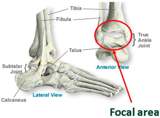 Finite Element Analysis of the Bearing Component of Total Ankle ...