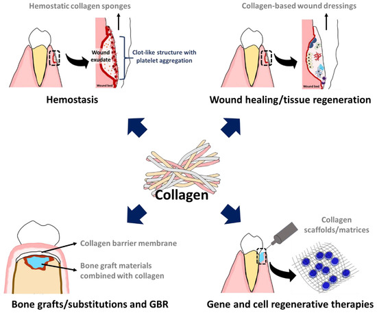 Collagen-Based Biomaterials in Periodontal Regeneration: Current ...