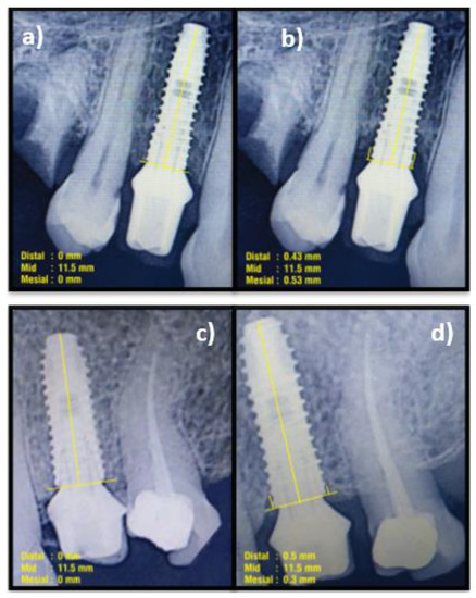 Clinical and Radiological Outcomes for Guided Implant Placement in ...