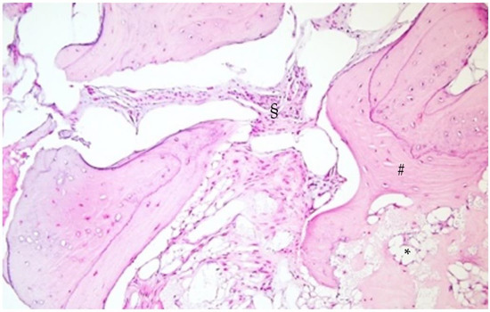 Guided Bone Regeneration with Occlusive Titanium Barrier: A Case Report ...