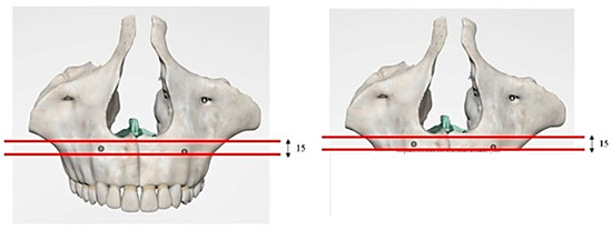 Finite Element Analysis (FEA) of a Premaxillary Device: A New Type of ...