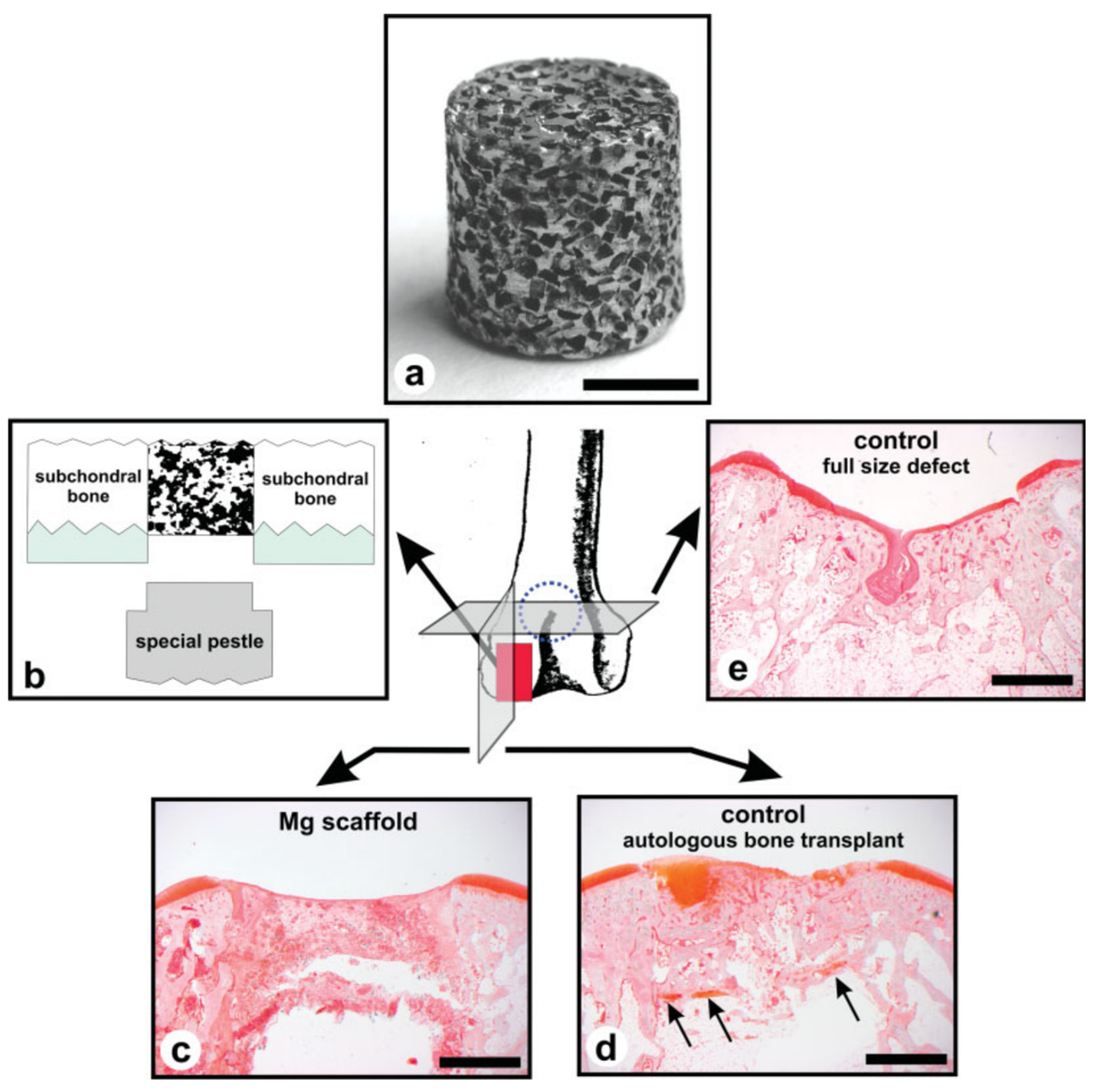 Bone Regeneration Induced by Patient-Adapted Mg Alloy-Based Scaffolds ...
